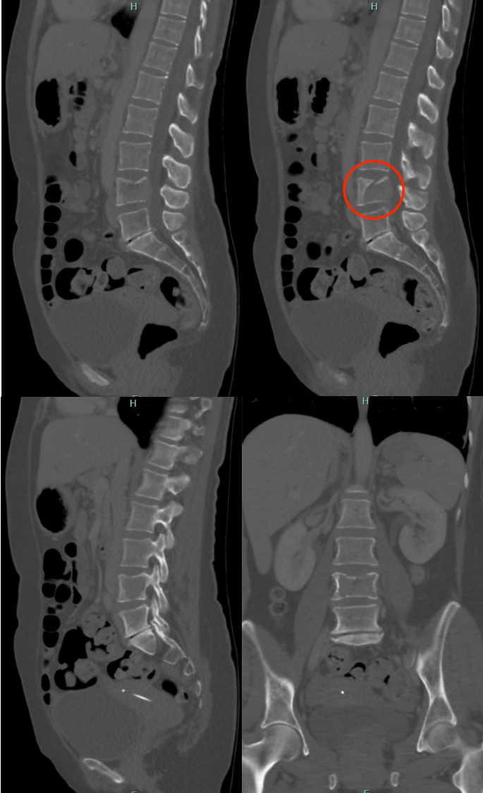 Spine Dragon - Spinal Conditions: Spinal Tumours and Infections